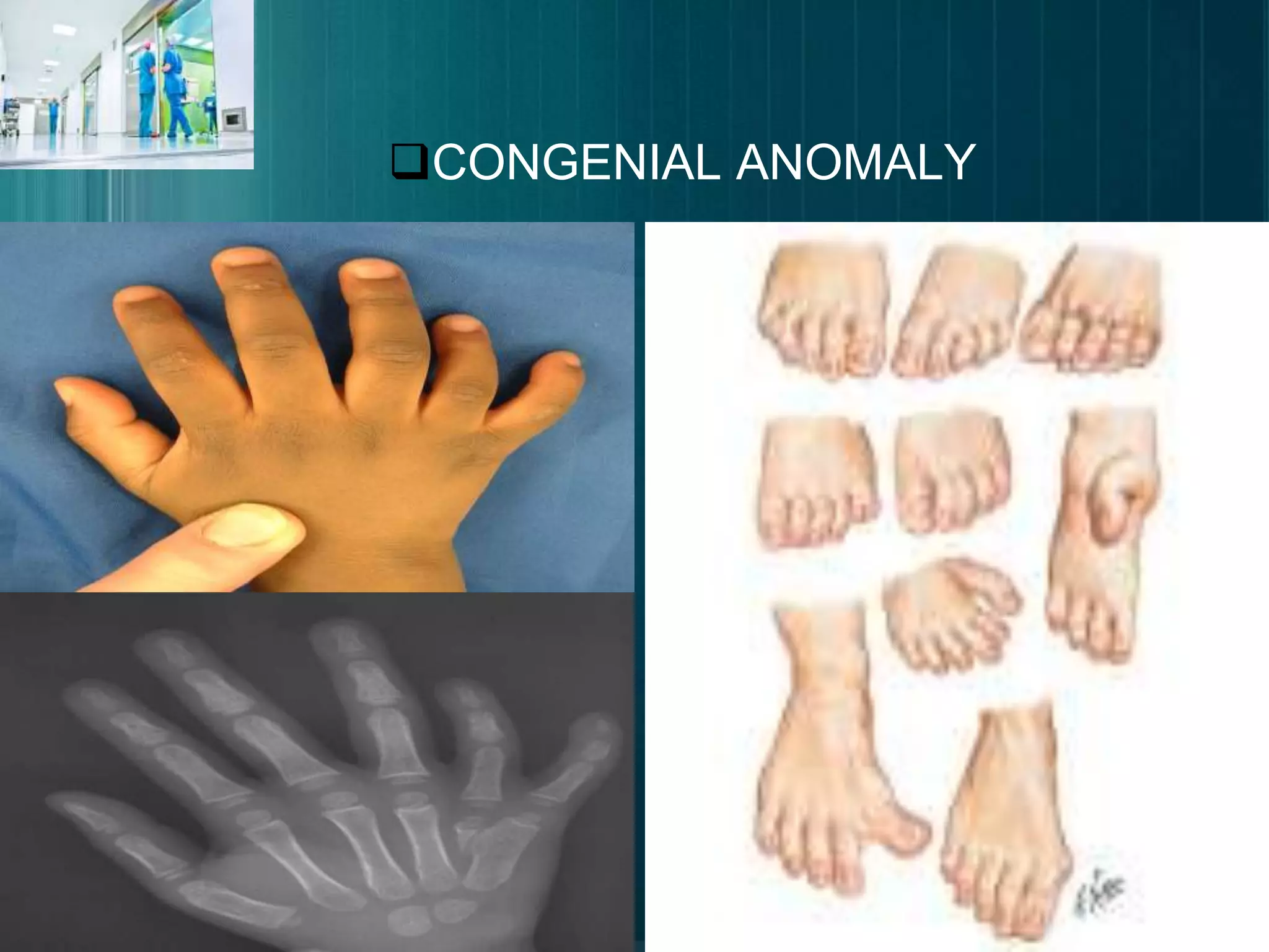 Amputation,Stump care, phantom limb pain and gait training in lower ...