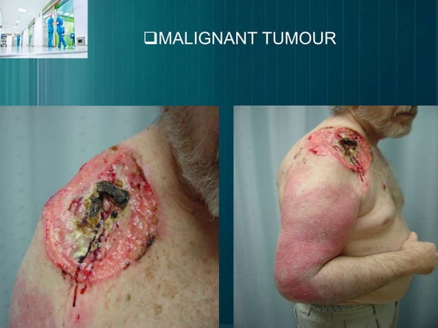 Amputation,Stump care, phantom limb pain and gait training in lower ...