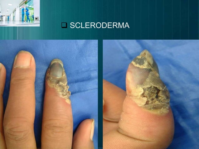 Amputation,Stump care, phantom limb pain and gait training in lower ...