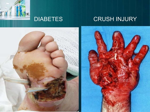 Amputation,Stump care, phantom limb pain and gait training in lower ...