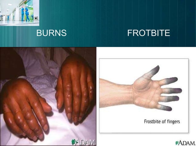 Amputation,Stump care, phantom limb pain and gait training in lower ...