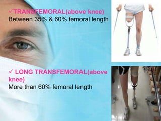 Amputation,Stump care, phantom limb pain and gait training in lower ...