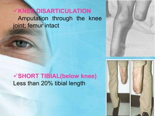 Amputation,Stump care, phantom limb pain and gait training in lower ...
