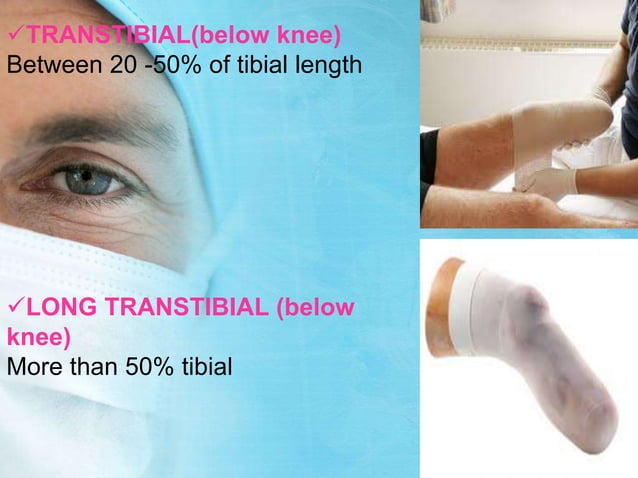 Amputation,Stump care, phantom limb pain and gait training in lower ...