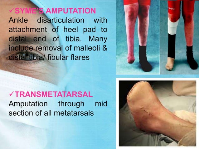 Amputation,Stump care, phantom limb pain and gait training in lower ...