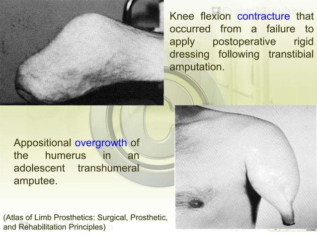 Amputation,Stump care, phantom limb pain and gait training in lower ...