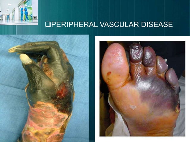 Amputation,Stump care, phantom limb pain and gait training in lower ...