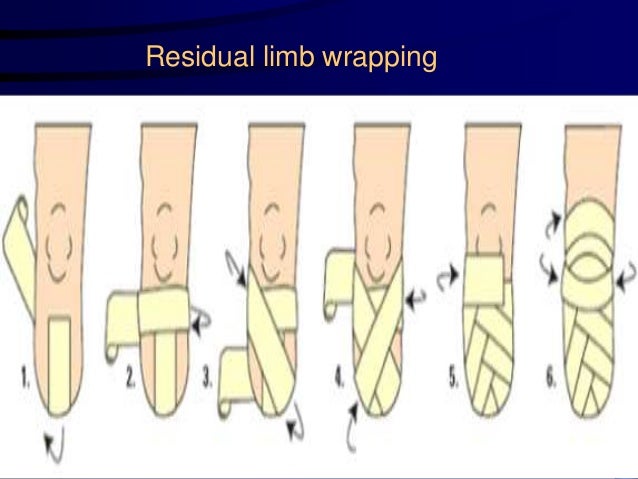 Amputation,Stump care, phantom limb pain and gait training in lower l…