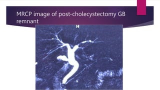 Stump stone after cholecystectomy.ppt