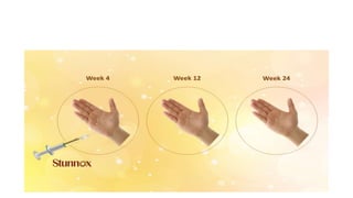 Stunnox in Hyperhidrosis.pptx