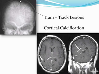 Tramline Intracranial Calcifications Sturge Weber