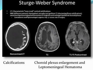 Tramline Intracranial Calcifications Sturge Weber