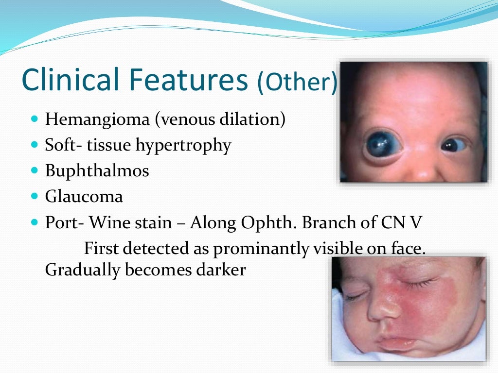 Sturge weber syndrome