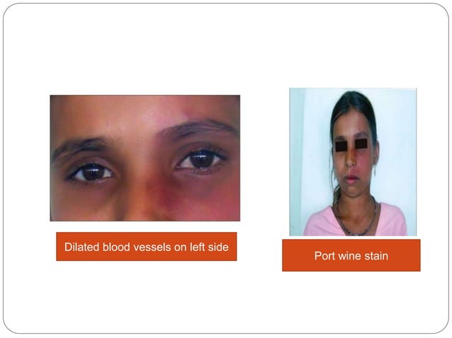 Sturge weber syndrome | PPTX | Dental Health | Diseases and Conditions