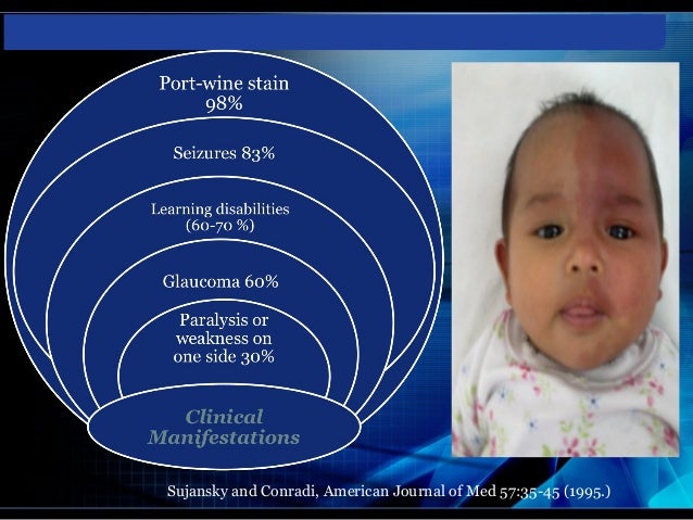 Sturge weber syndrome