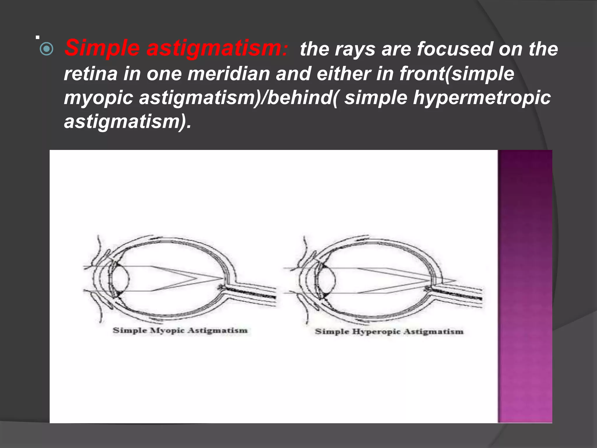 Sturm's conoid | PPTX