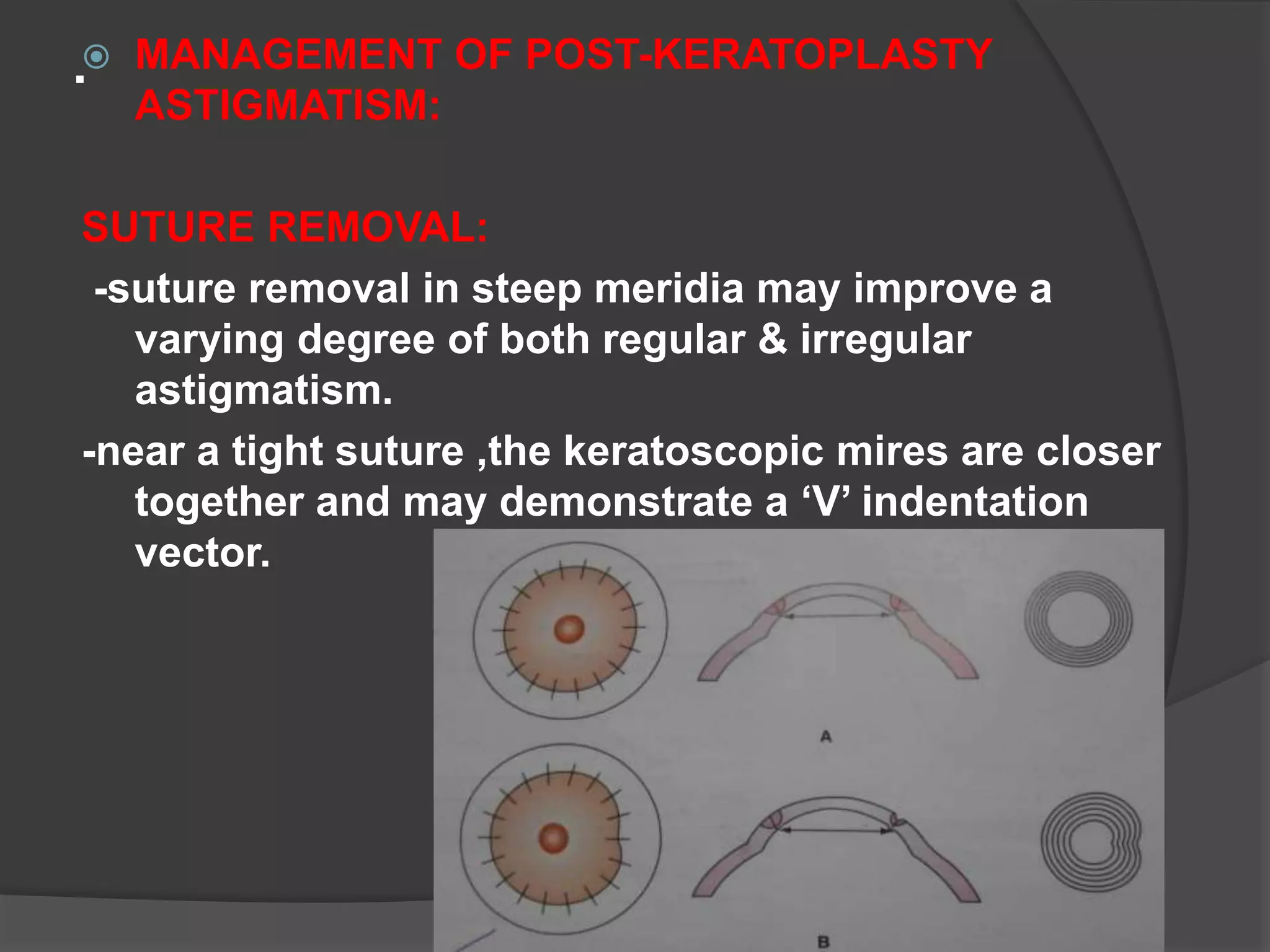 Sturm's conoid | PPTX