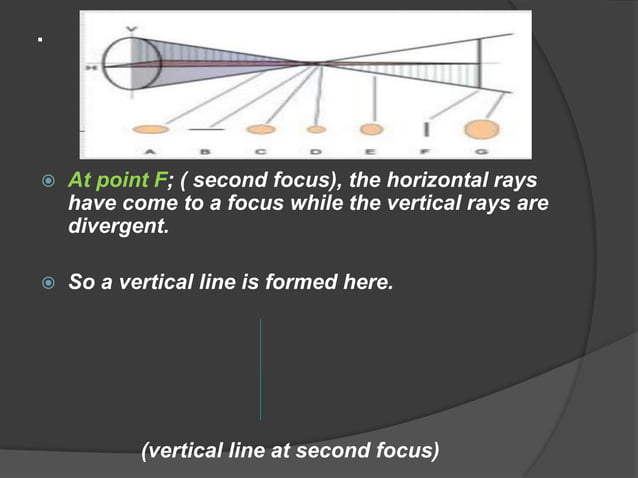 Sturm's conoid | PPTX | Eye and Vision Conditions | Diseases and Conditions