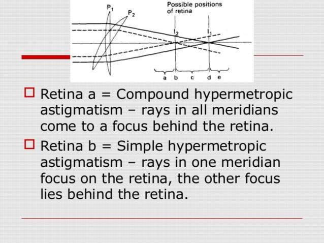 Sturm's conoid | PPTX | Eye and Vision Conditions | Diseases and Conditions