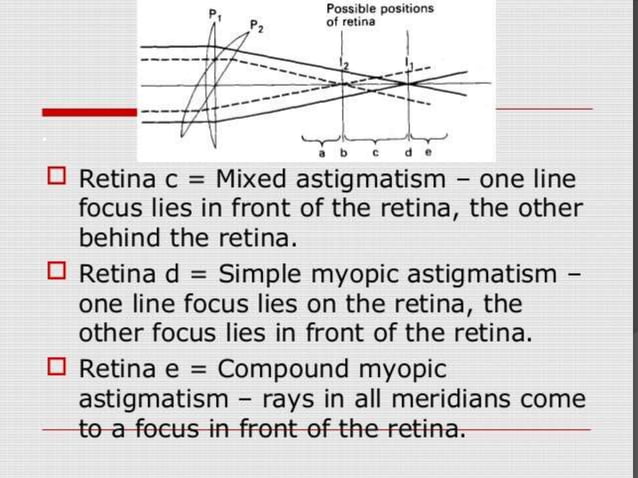 Sturm's conoid | PPTX | Eye and Vision Conditions | Diseases and Conditions