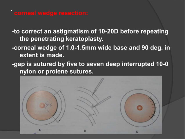 Sturm's conoid | PPTX | Eye and Vision Conditions | Diseases and Conditions