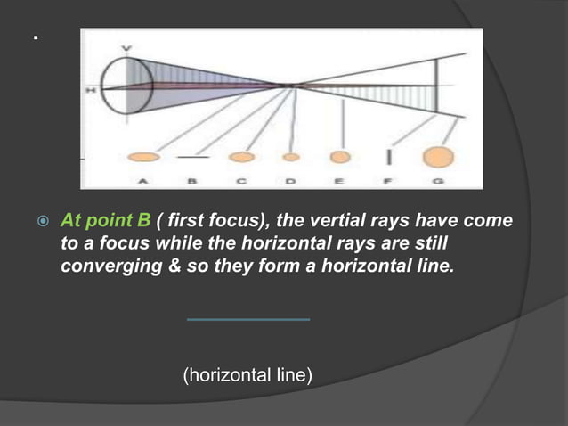 Sturm's conoid | PPTX | Eye and Vision Conditions | Diseases and Conditions