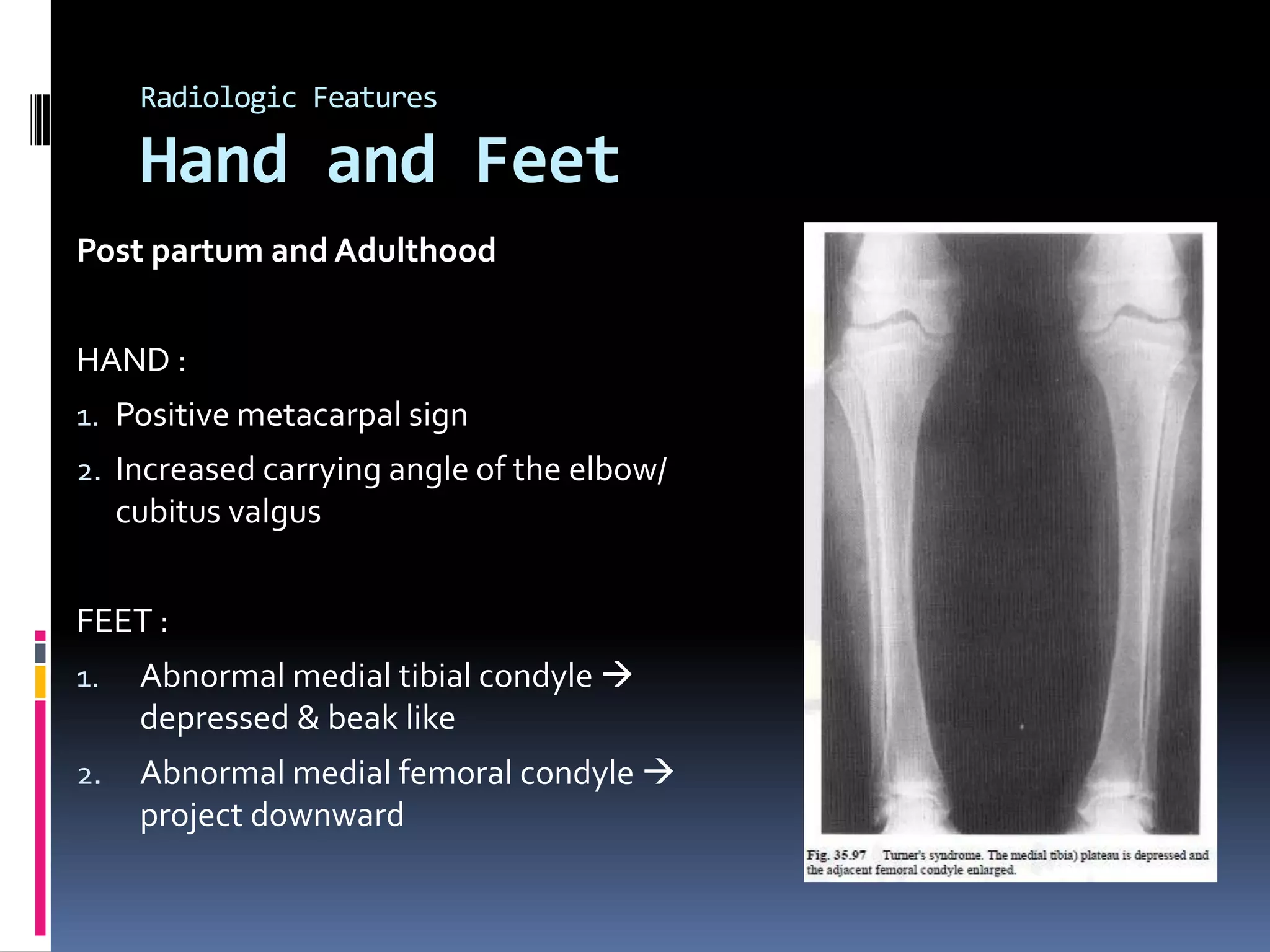 Turner's Syndrome | PDF