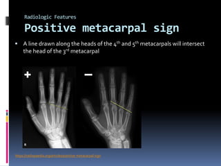 Turner's Syndrome | PDF