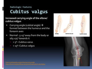 Turner's Syndrome | PDF
