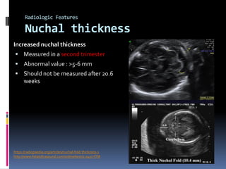 Turner's Syndrome | PDF
