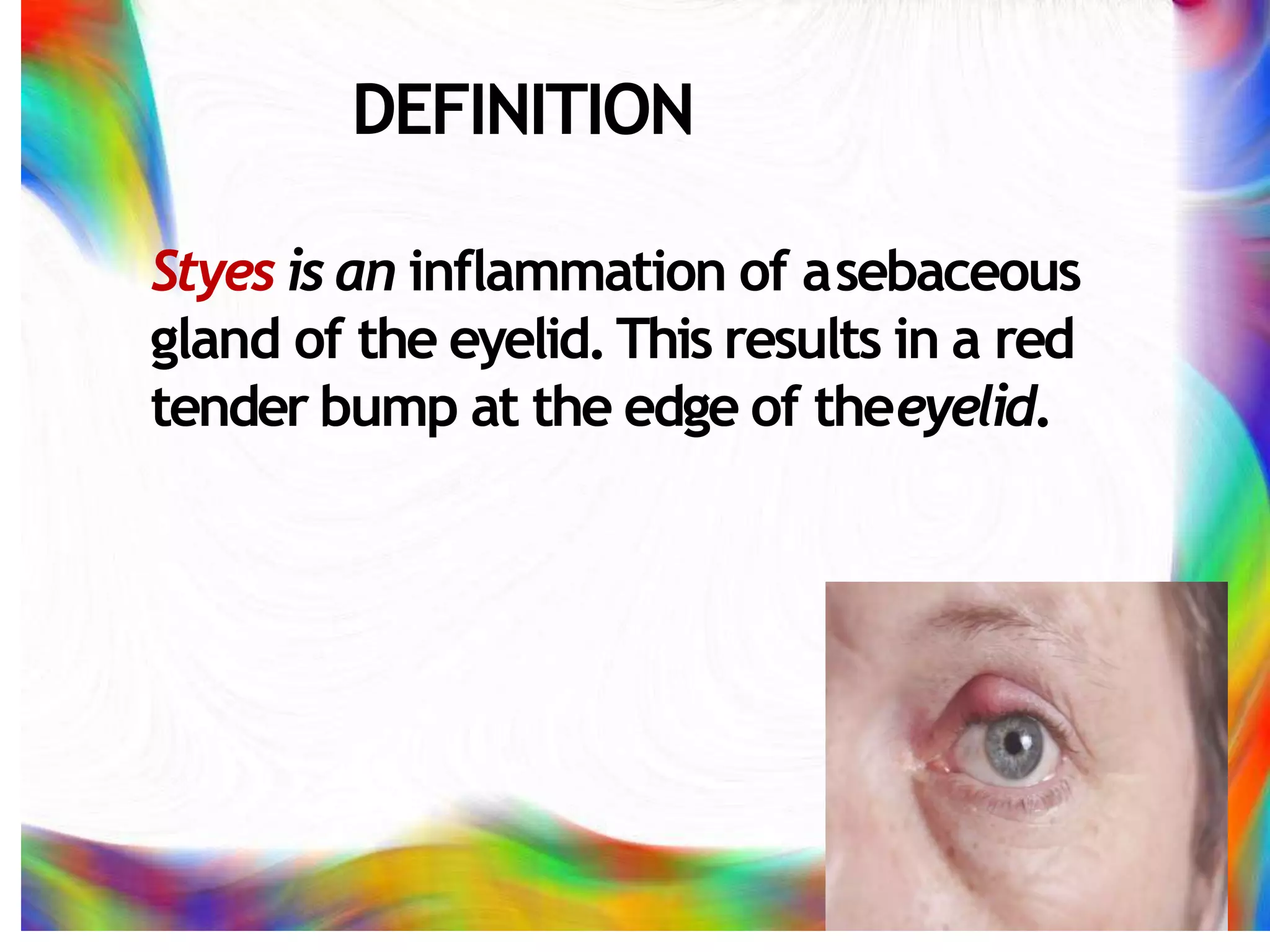 Stye or hordeolum | PPTX