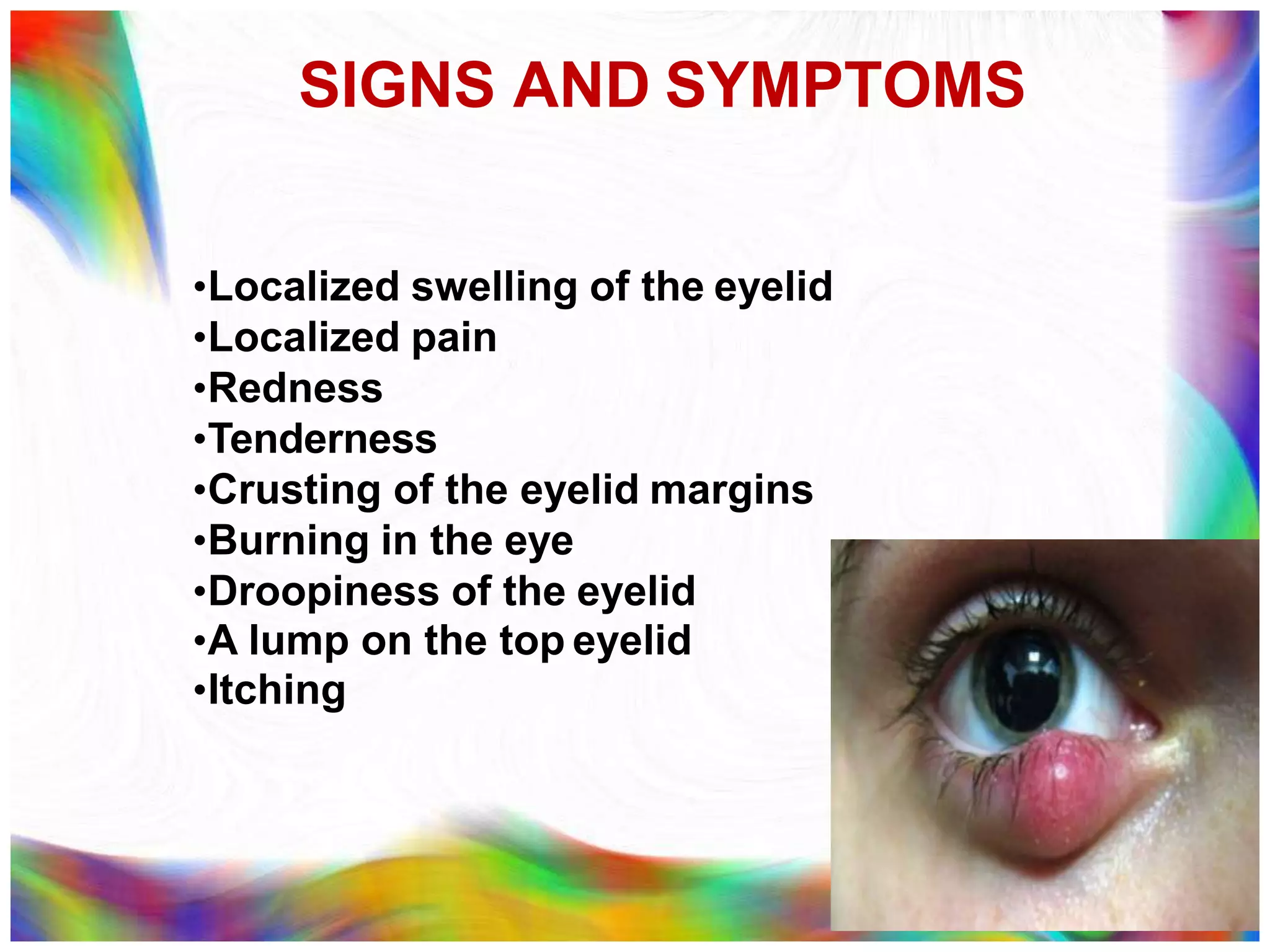 Stye or hordeolum | PPTX