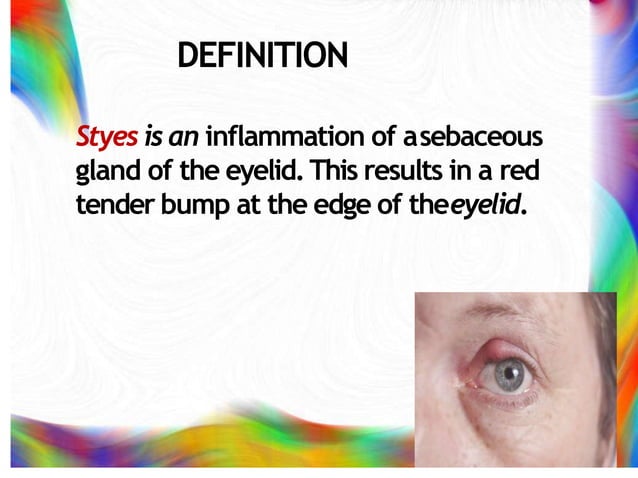 Stye or hordeolum | PPTX | Eye and Vision Conditions | Diseases and ...