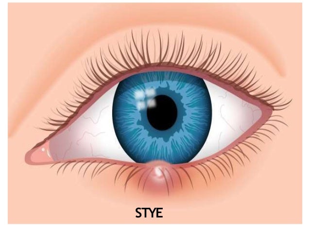 Stye or hordeolum
