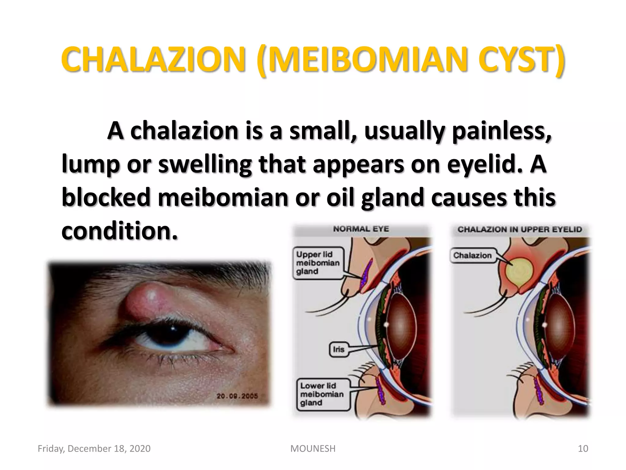 Stye & chalazion | PPTX