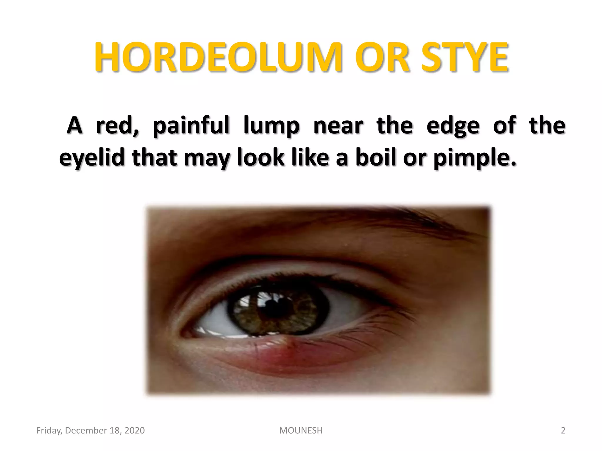 Stye & chalazion | PPTX