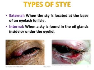 Stye & chalazion | PPTX