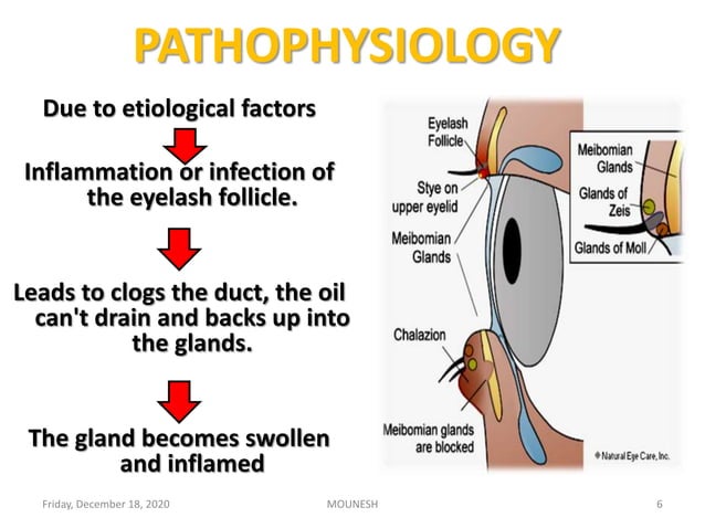 Stye & chalazion