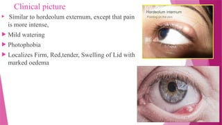 Stye, CHALAZION, Internal hordeolum.pptx