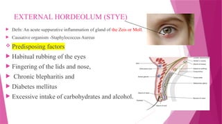 Stye, CHALAZION, Internal hordeolum.pptx
