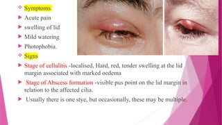 Stye, CHALAZION, Internal hordeolum.pptx