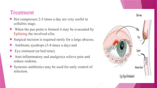 Stye, CHALAZION, Internal hordeolum.pptx