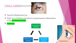 Stye, CHALAZION, Internal hordeolum.pptx