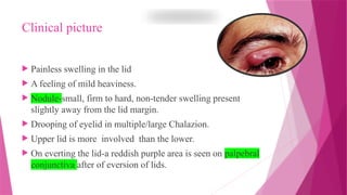 Stye, CHALAZION, Internal hordeolum.pptx
