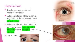 Stye, CHALAZION, Internal hordeolum.pptx