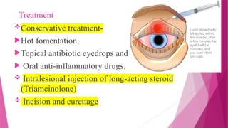 Stye CHALAZION Internal Hordeolum pptx Stye CHALAZION Internal Hordeolum pptx