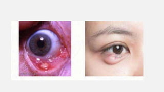 stye disease.pptx