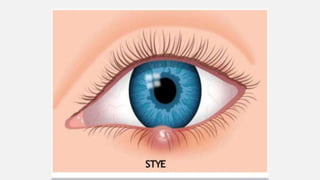 stye disease.pptx