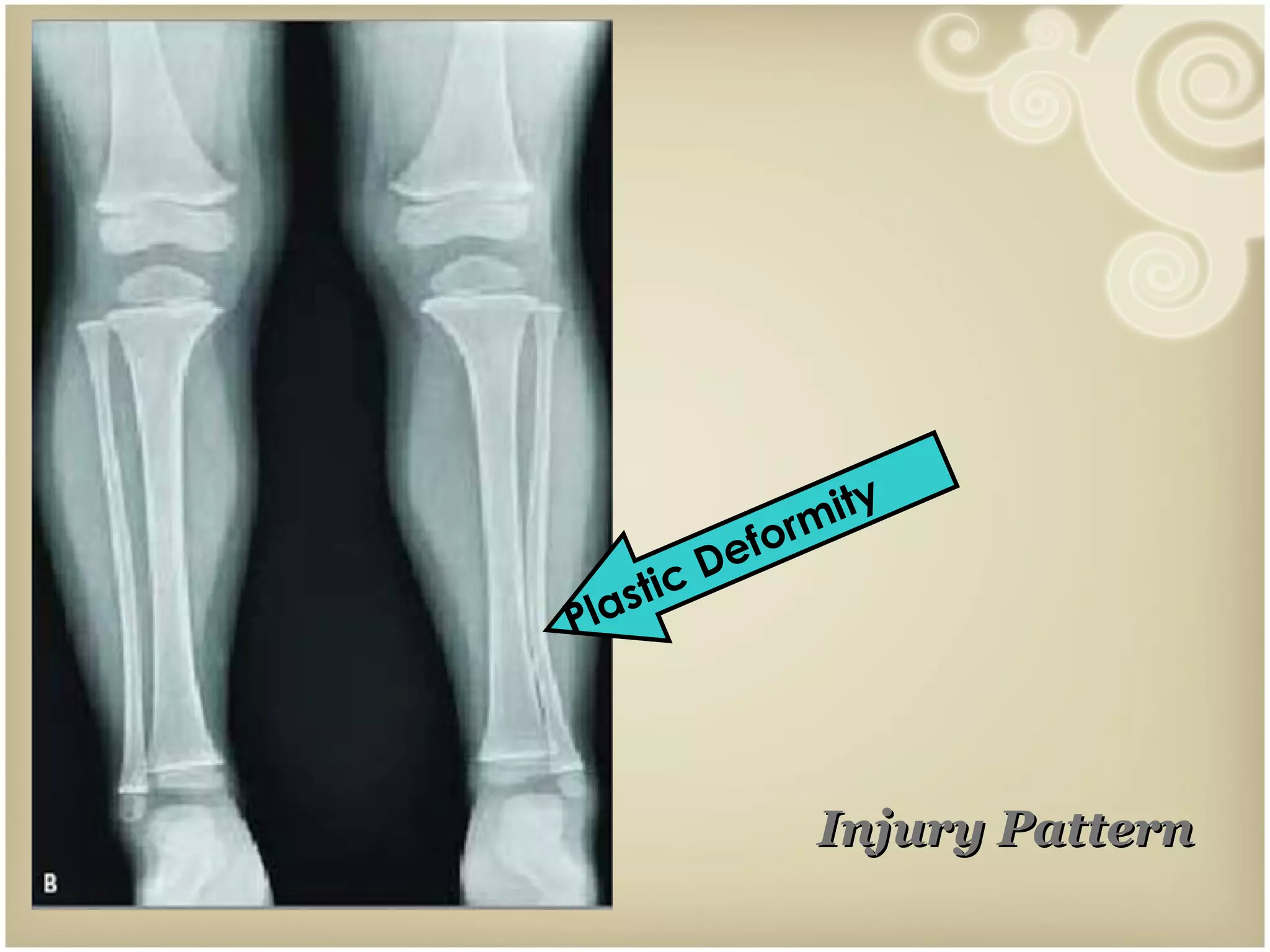 Paediatric fracture | PPT