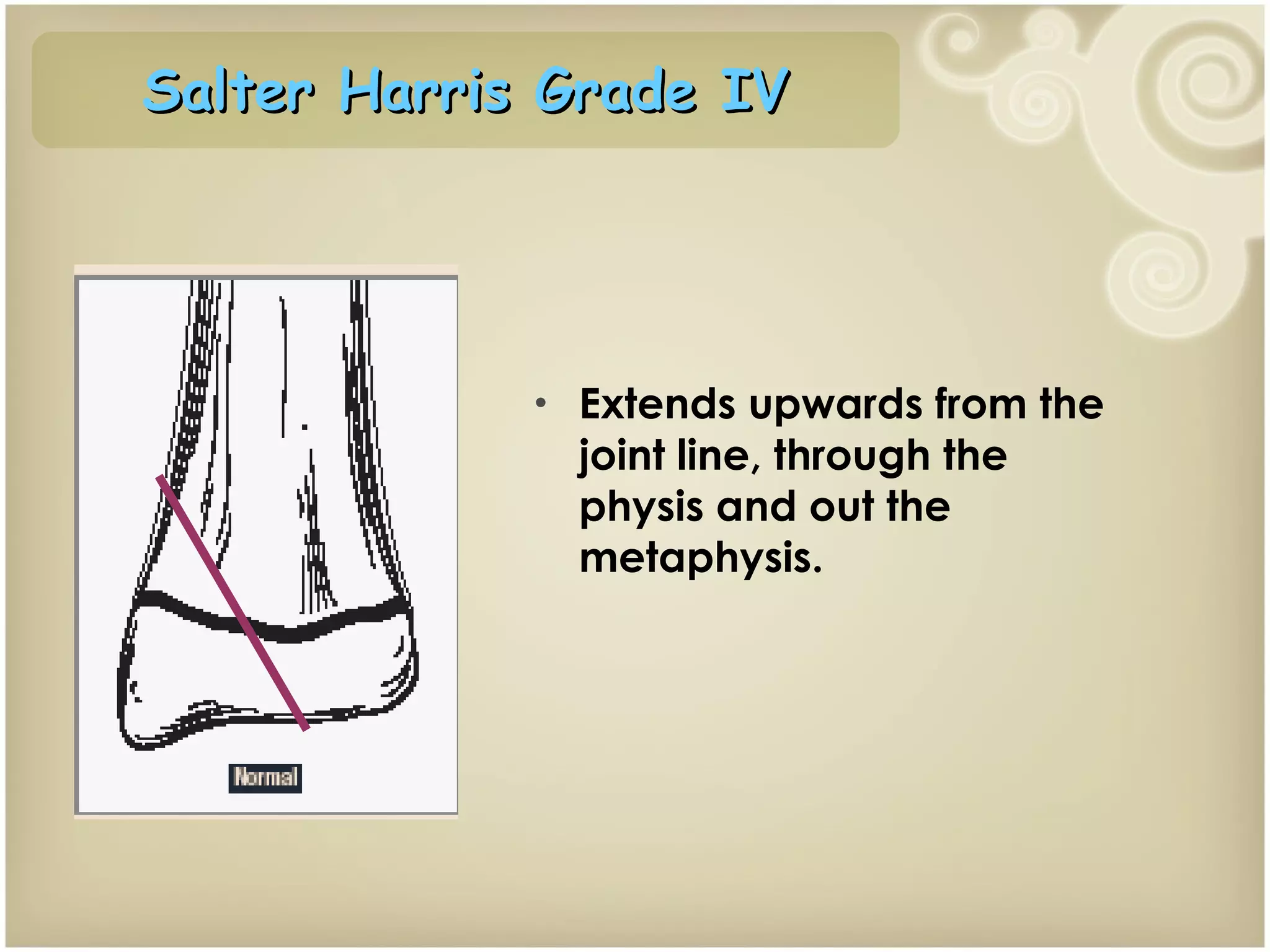 Paediatric fracture | PPT